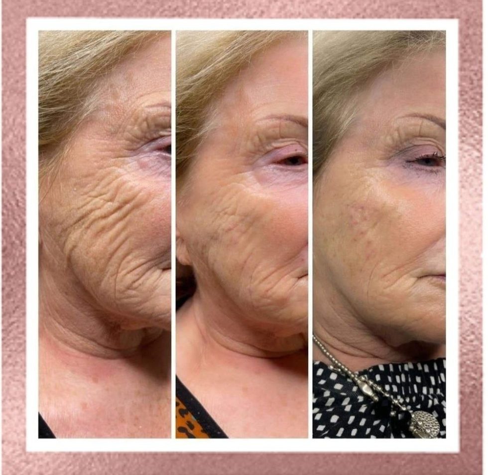 Profhilo Skin Booster - Skinique Aesthetics